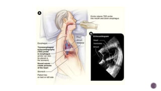 Myocardial injury after non cardiac surgery (MINS.pptx