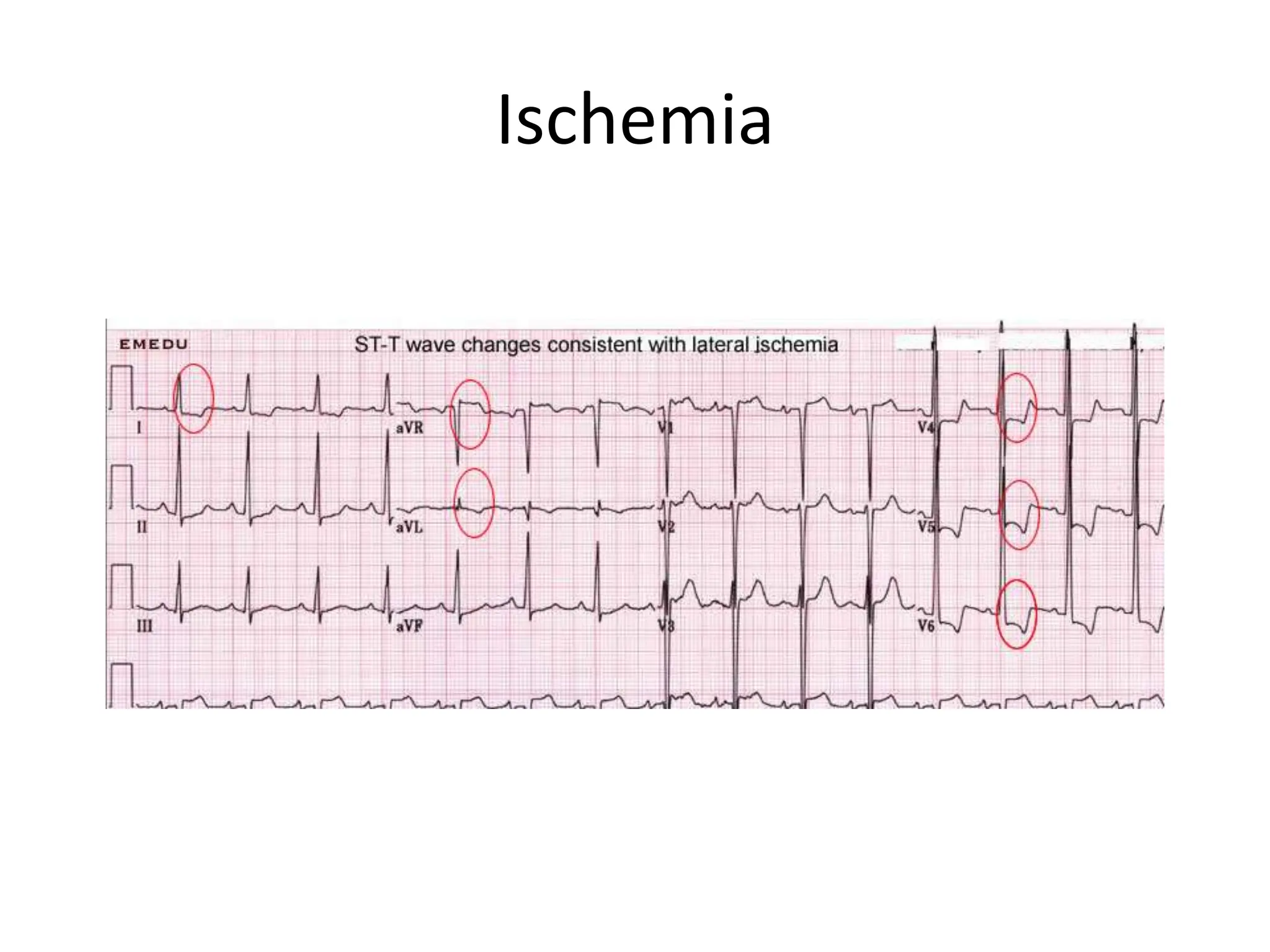 acute coronary syndrome (infarction and ischemia) | PPT | Heart and ...