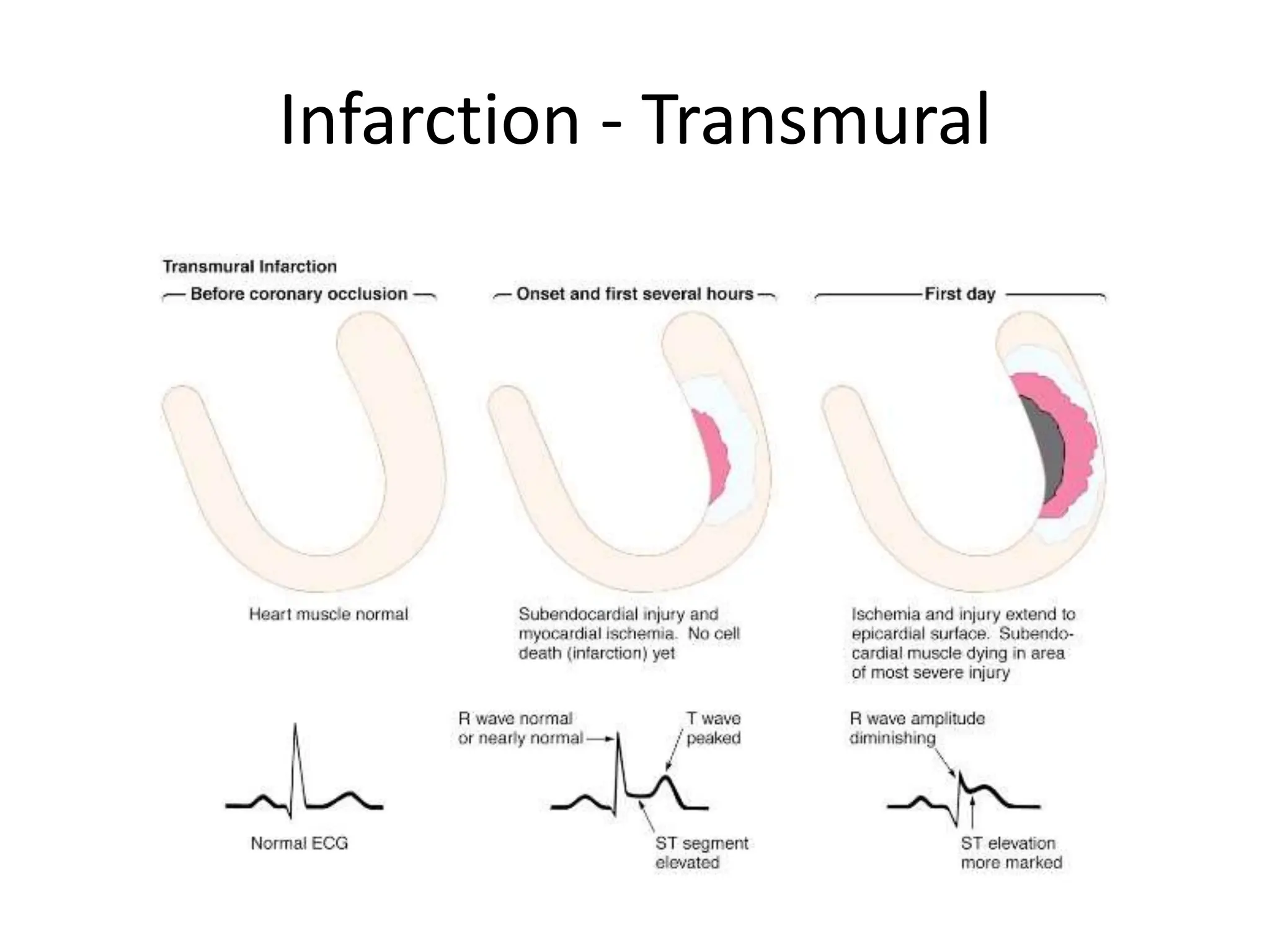 acute coronary syndrome (infarction and ischemia) | PPT