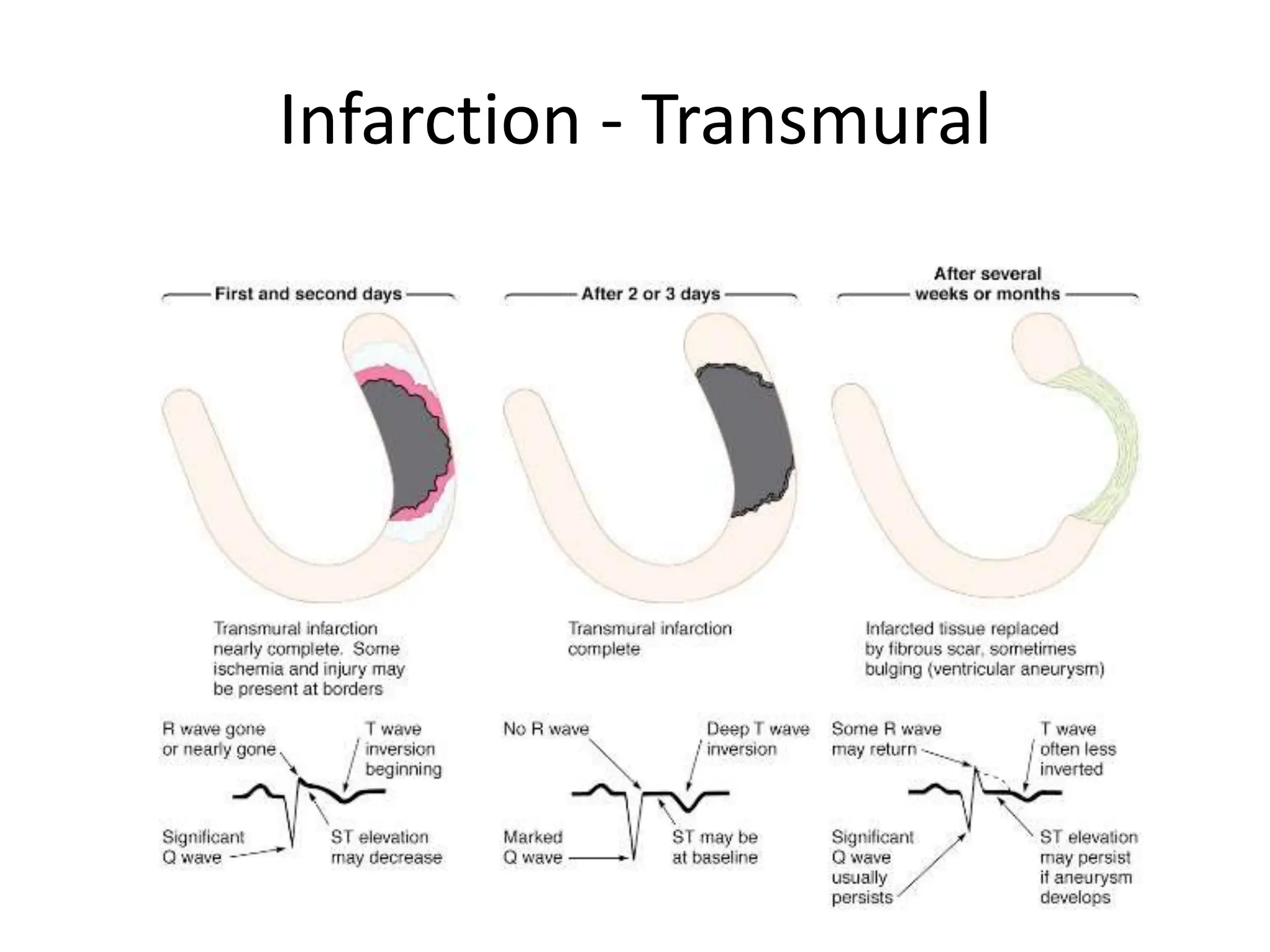 acute coronary syndrome (infarction and ischemia) | PPT