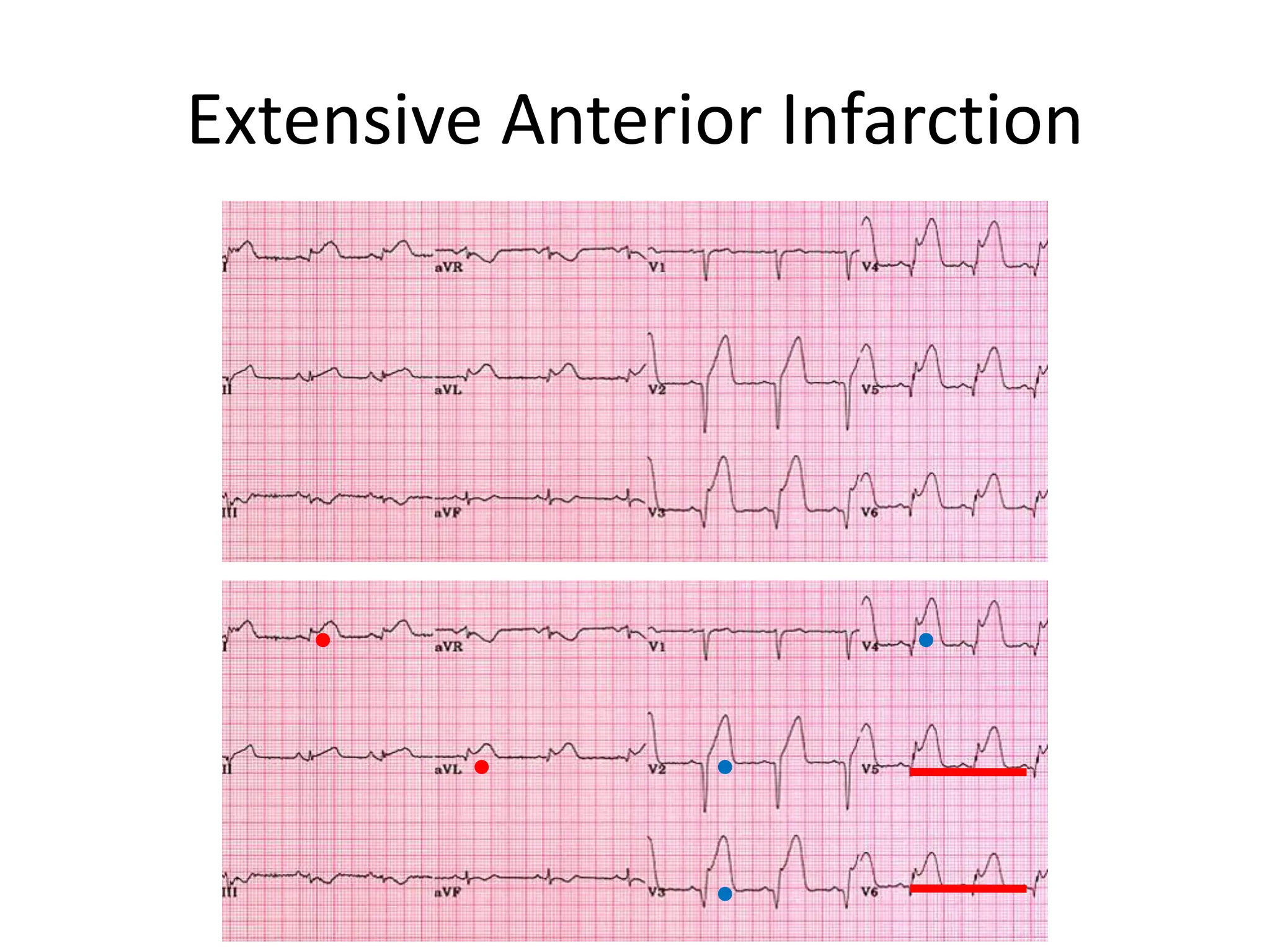 acute coronary syndrome (infarction and ischemia) | PPT | Heart and ...