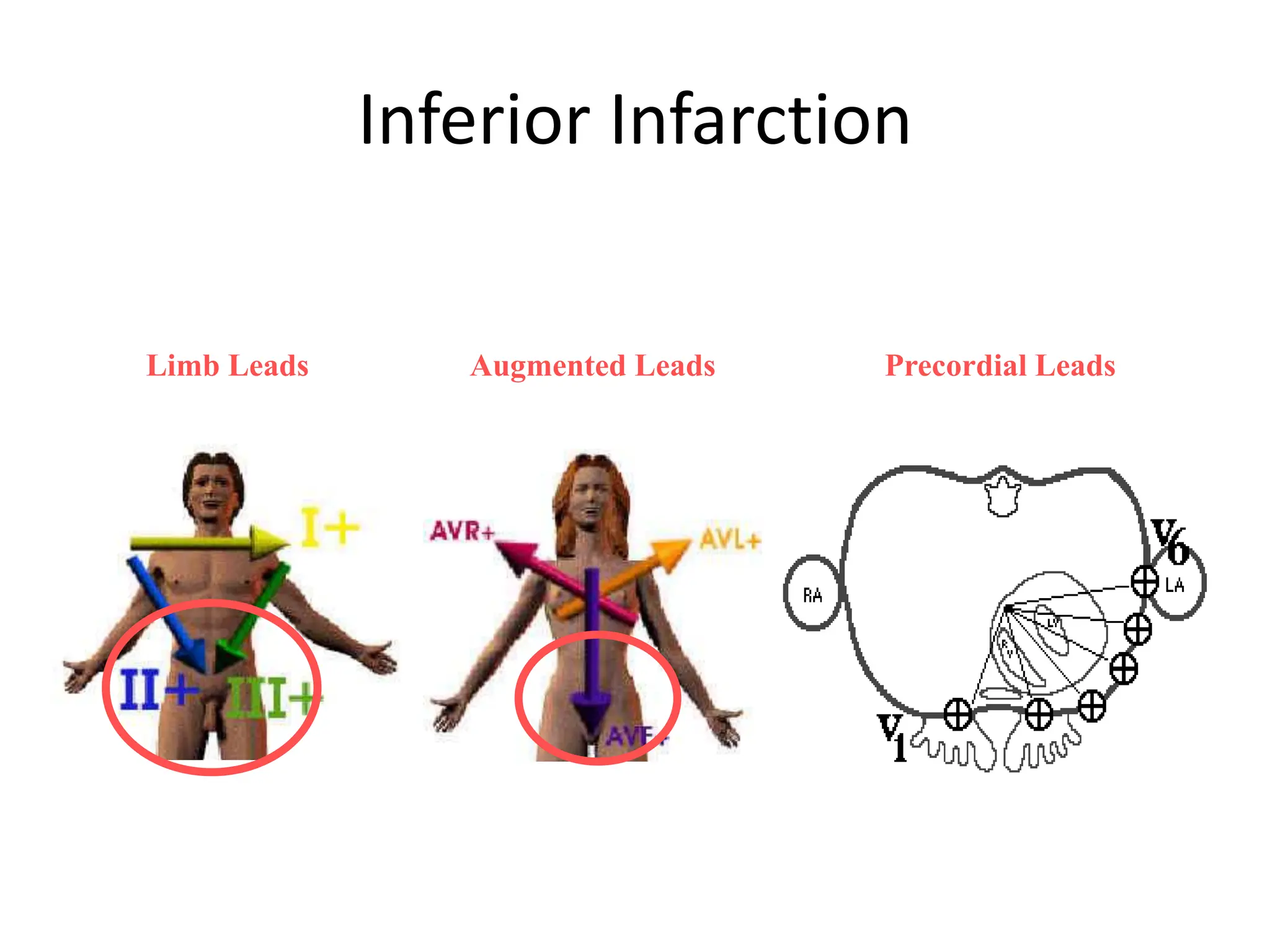 acute coronary syndrome (infarction and ischemia) | PPT | Heart and ...