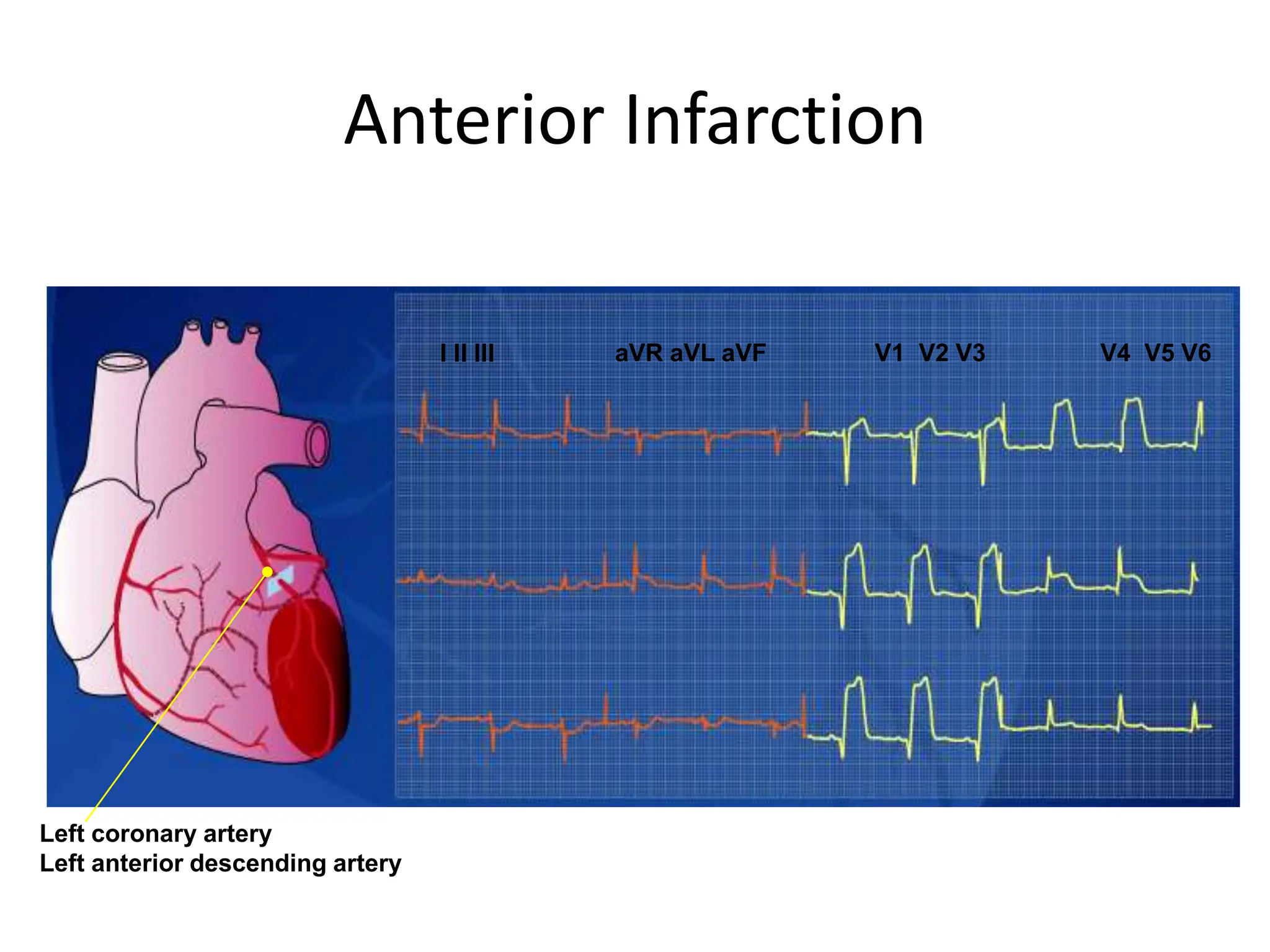 acute coronary syndrome (infarction and ischemia) | PPT | Heart and ...