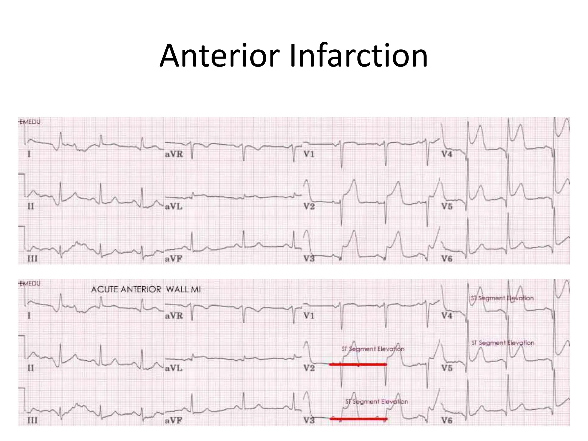 acute coronary syndrome (infarction and ischemia) | PPT