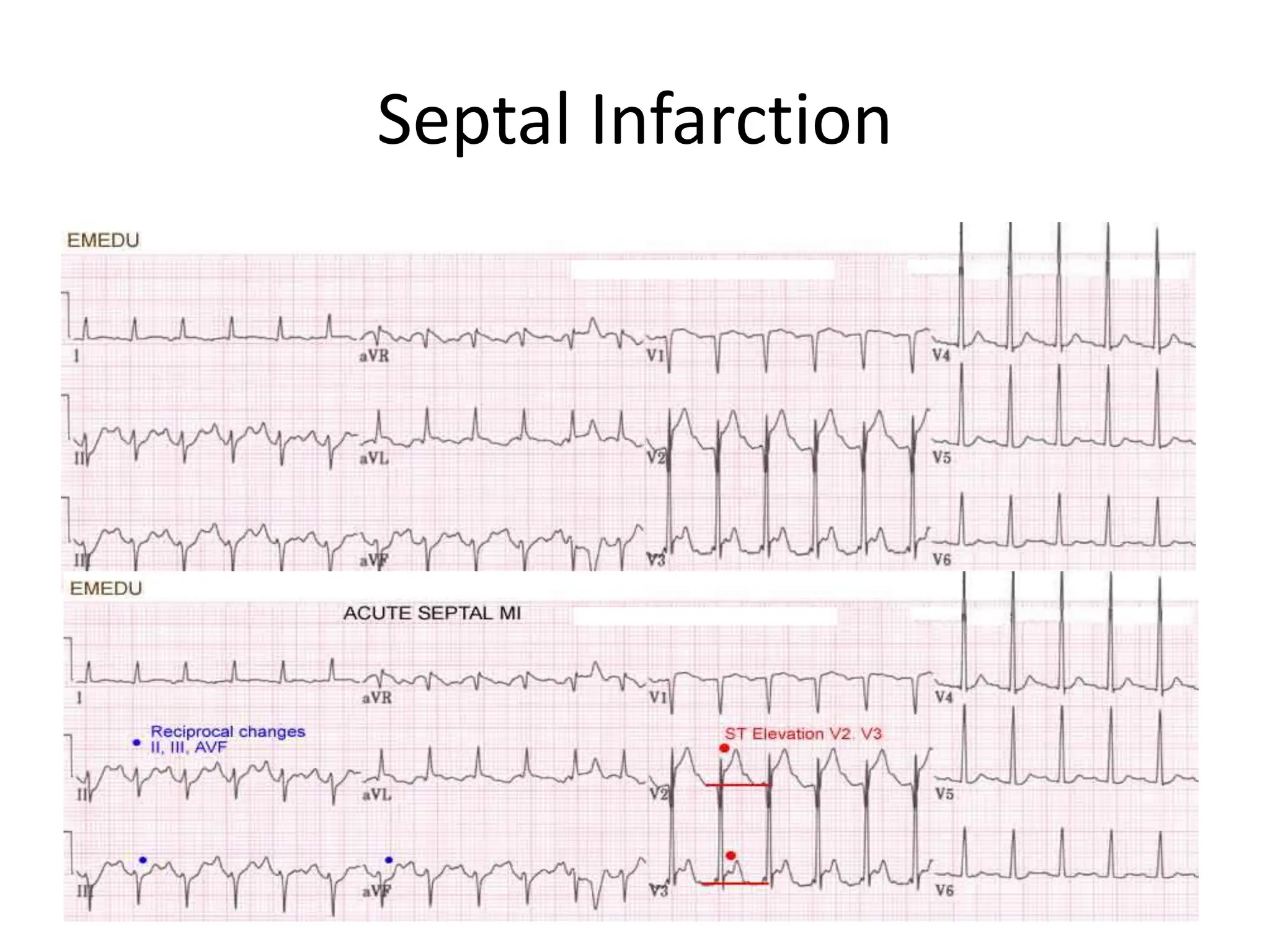 acute coronary syndrome (infarction and ischemia) | PPT | Heart and ...