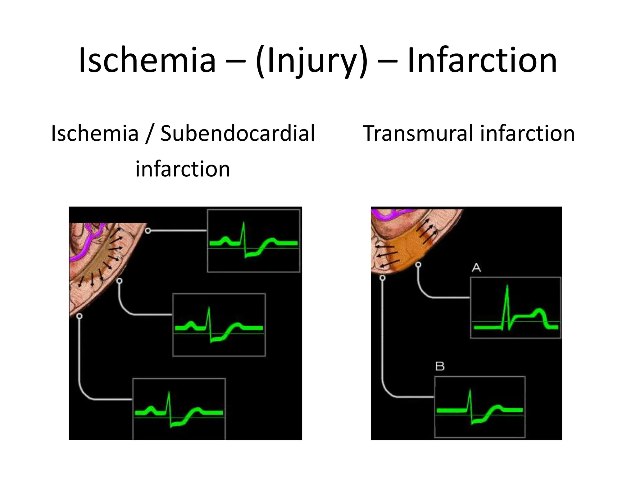 acute coronary syndrome (infarction and ischemia) | PPT | Heart and ...
