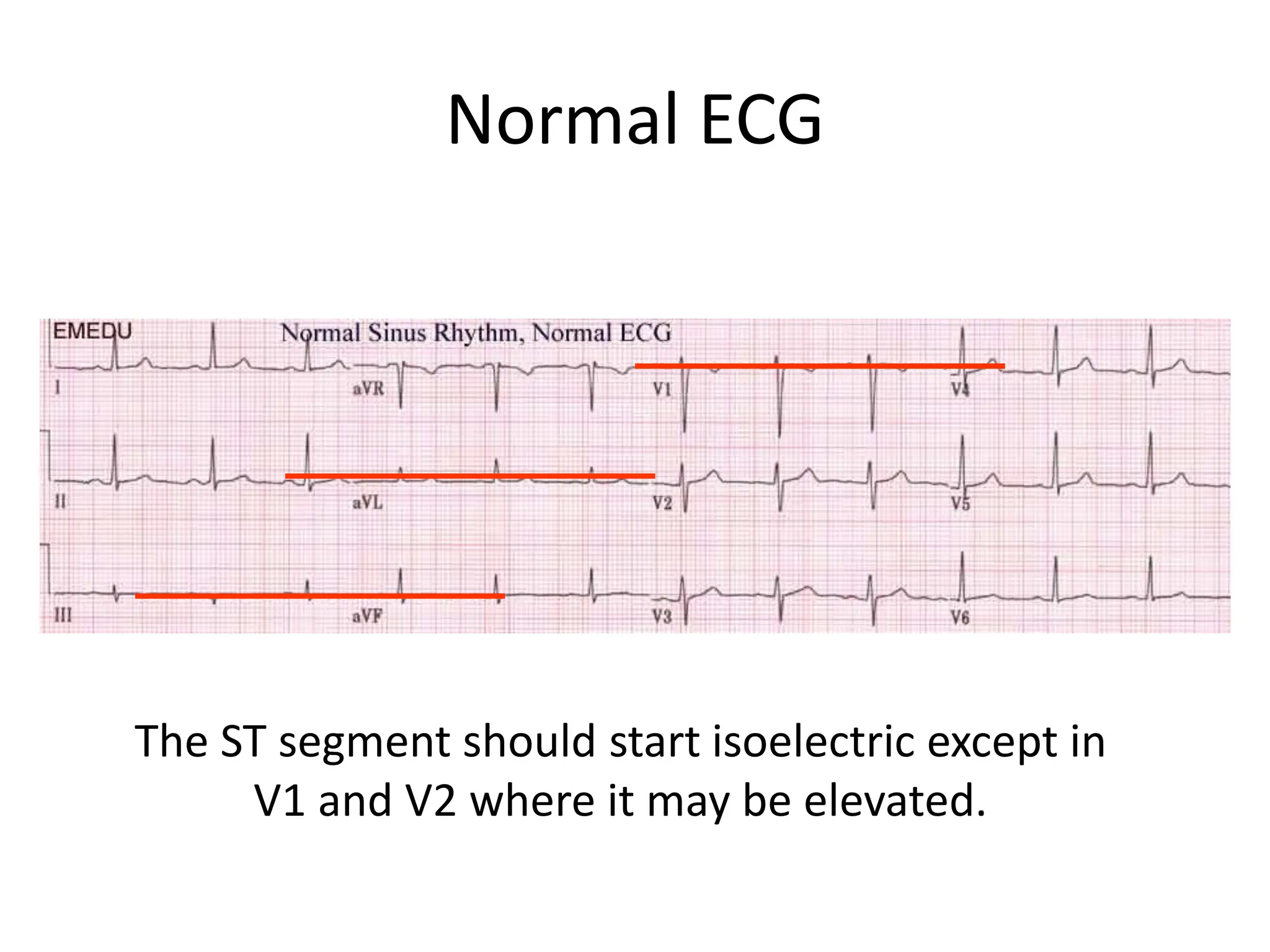acute coronary syndrome (infarction and ischemia) | PPT | Heart and ...