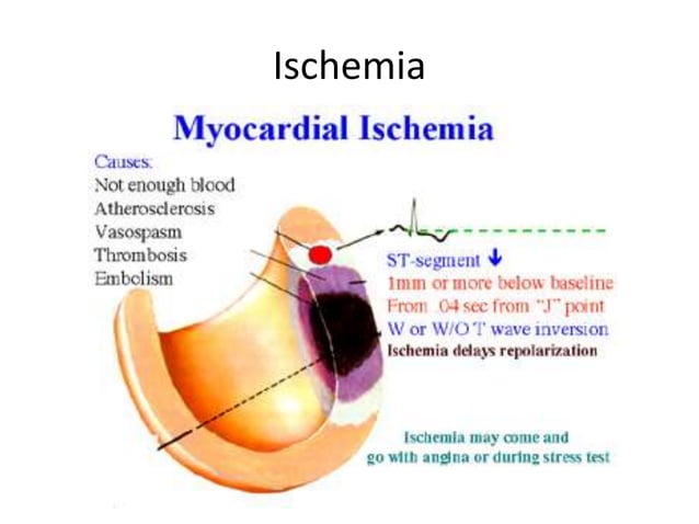 acute coronary syndrome (infarction and ischemia) | PPT