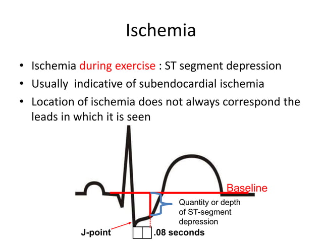 acute coronary syndrome (infarction and ischemia) | PPT