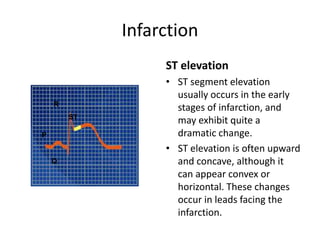 acute coronary syndrome (infarction and ischemia) | PPT