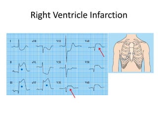 acute coronary syndrome (infarction and ischemia) | PPT