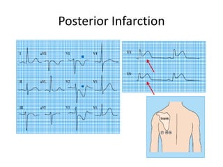 acute coronary syndrome (infarction and ischemia) | PPT