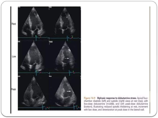 myocardial viability in severe lv dysfunction | PPT