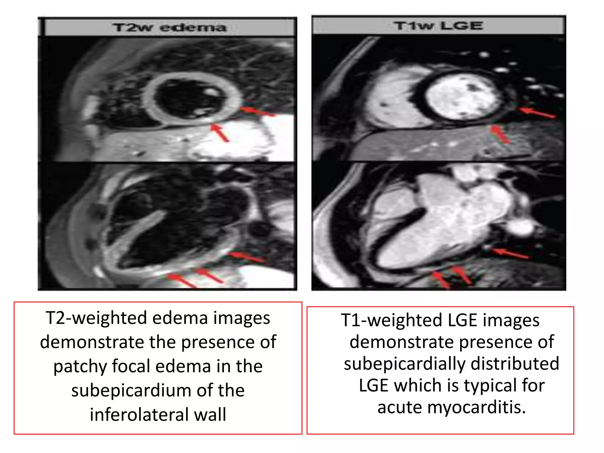Myocarditis | PPTX