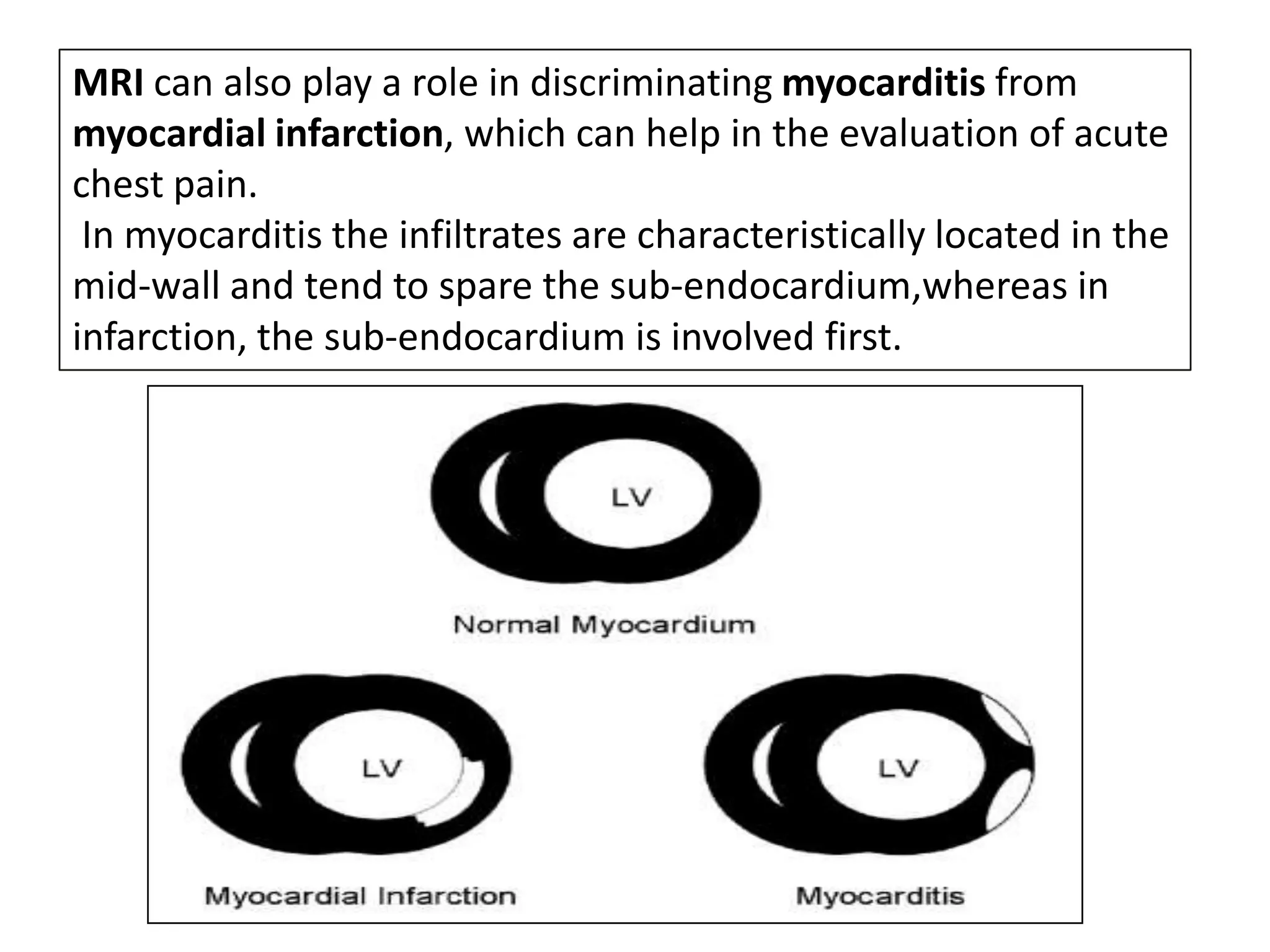 Myocarditis | PPTX