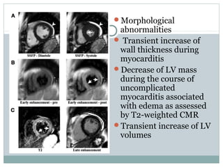 Myocarditis | PPT