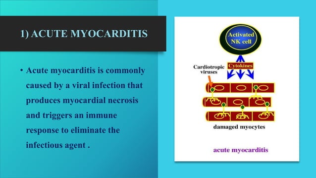 MYOCARDITIS | PDF | Heart and Cardiovascular Diseases | Diseases and ...