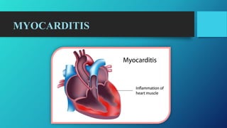 MYOCARDITIS | PPT