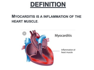 Myocarditis | PPT