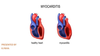 Myocarditis | PPT
