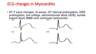 Myocarditis.pptx