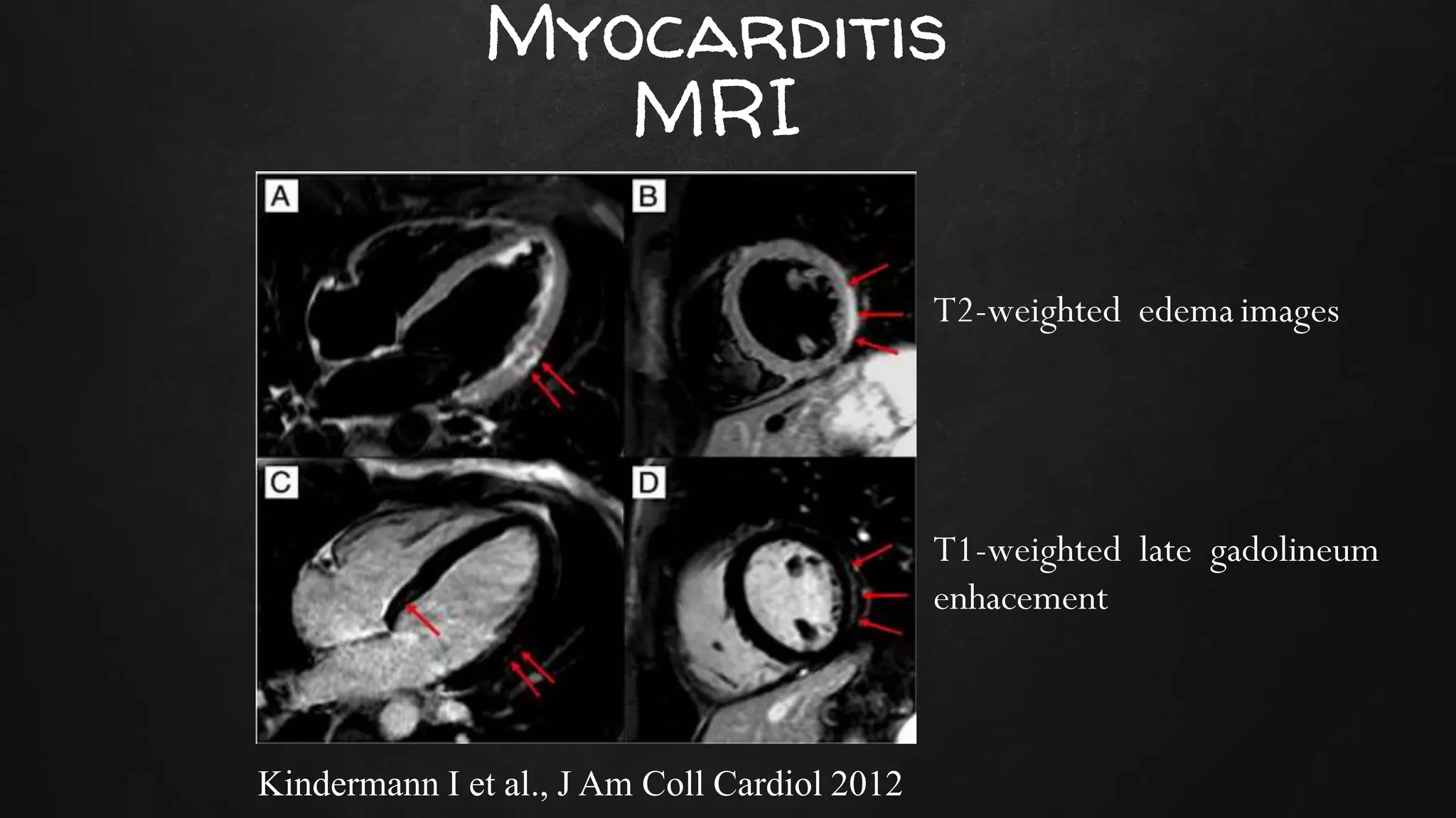 Myocarditis pediatrics ppt | PPTX