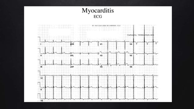 Myocarditis pediatrics ppt | PPTX