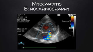 Myocarditis pediatrics ppt | PPTX