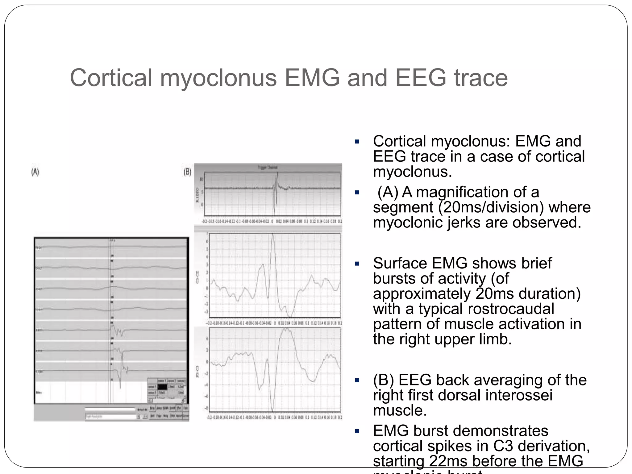 Myoclonus seizure | PPTX