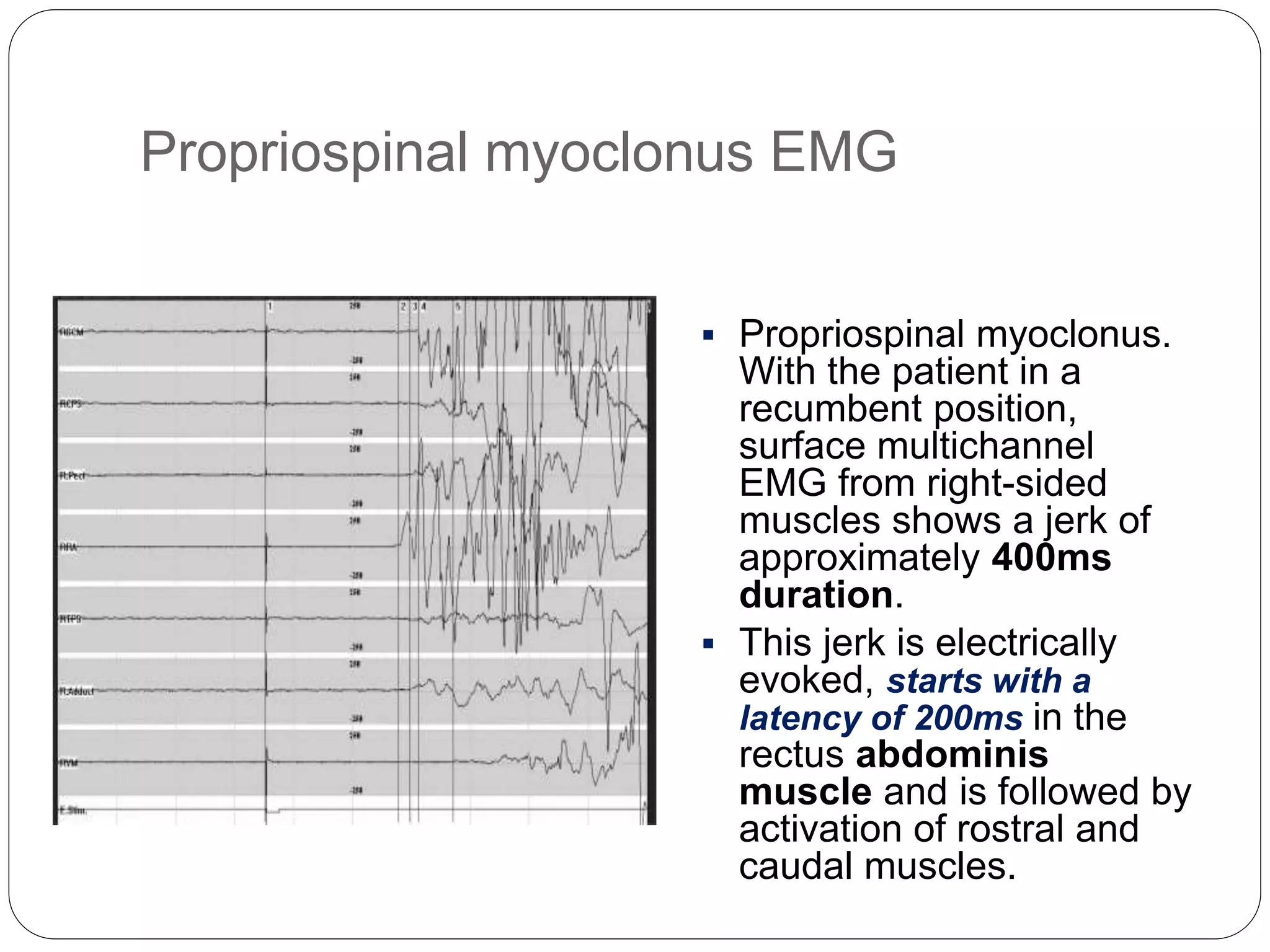 Myoclonus seizure | PPTX