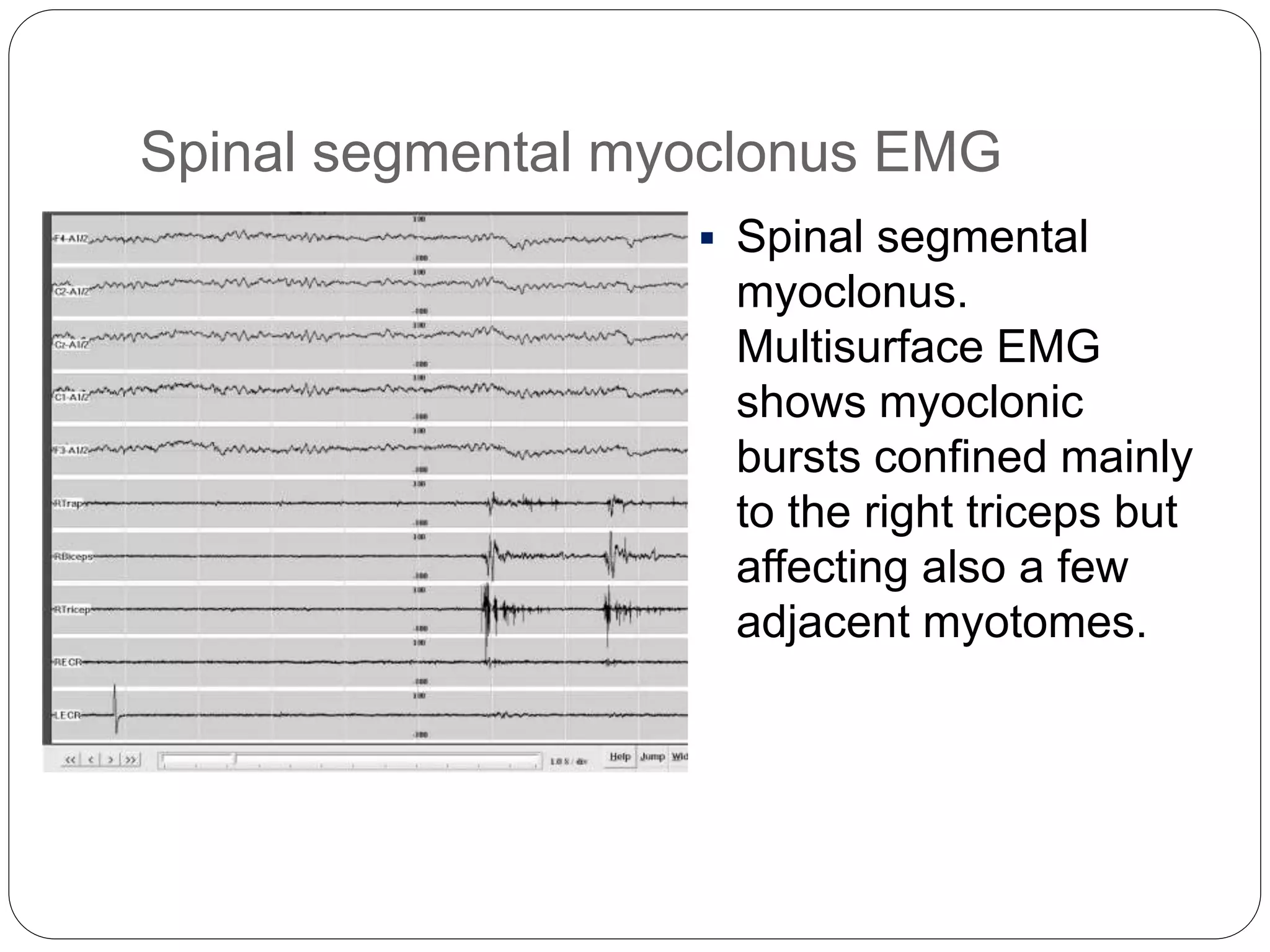 Myoclonus seizure | PPTX