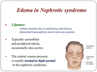 Periorbital Edema Nephrotic Syndrome