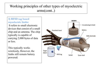 Myoelectric prosthesis | PPTX