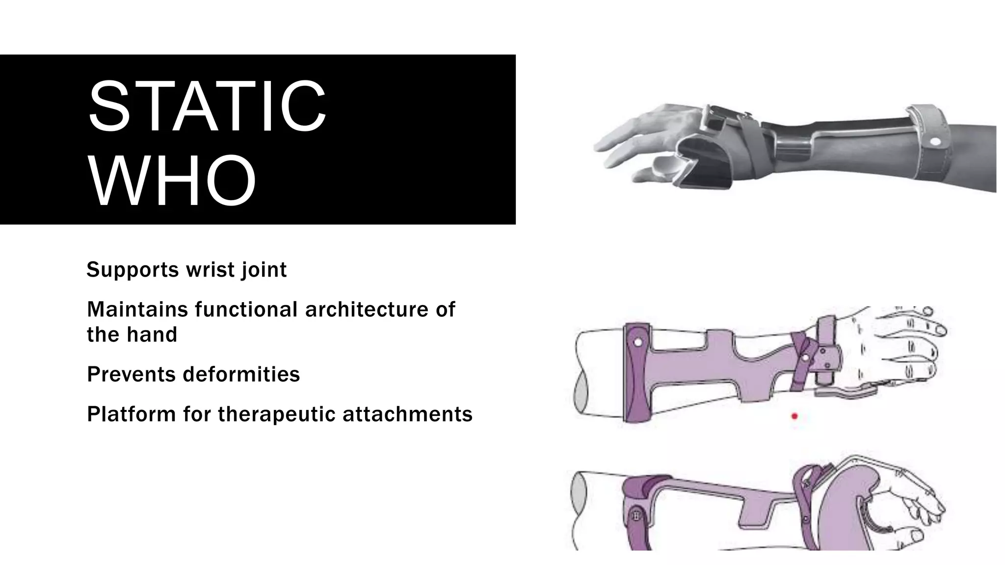 orthosis and prosthesis of upper limb | PPTX