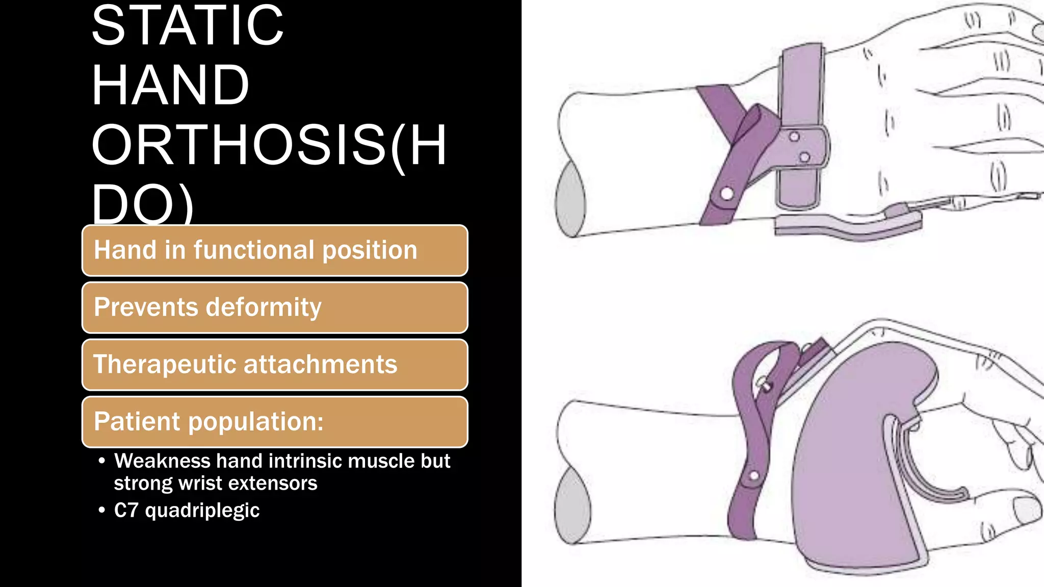 orthosis and prosthesis of upper limb | PPTX