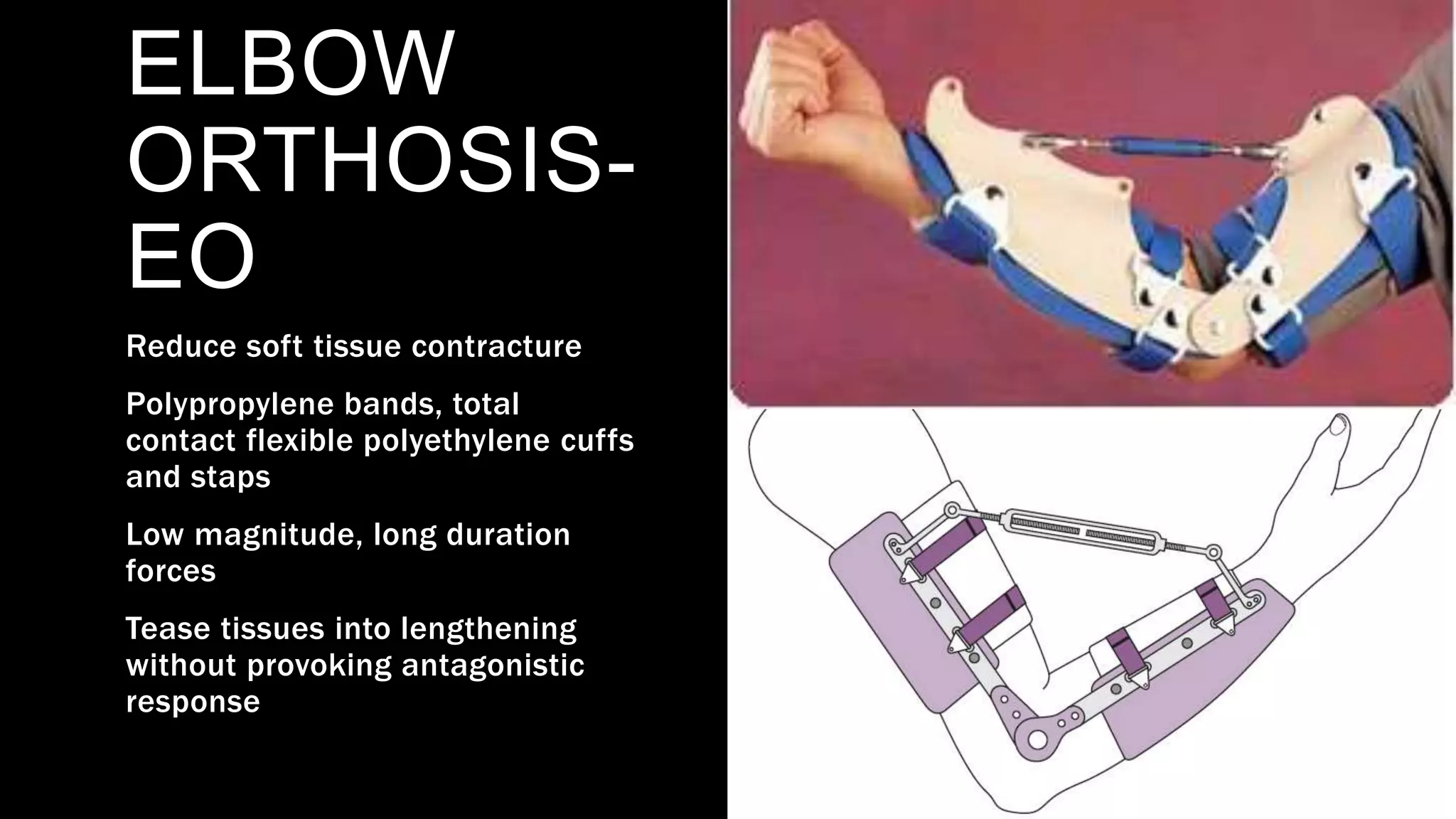 orthosis and prosthesis of upper limb | PPTX