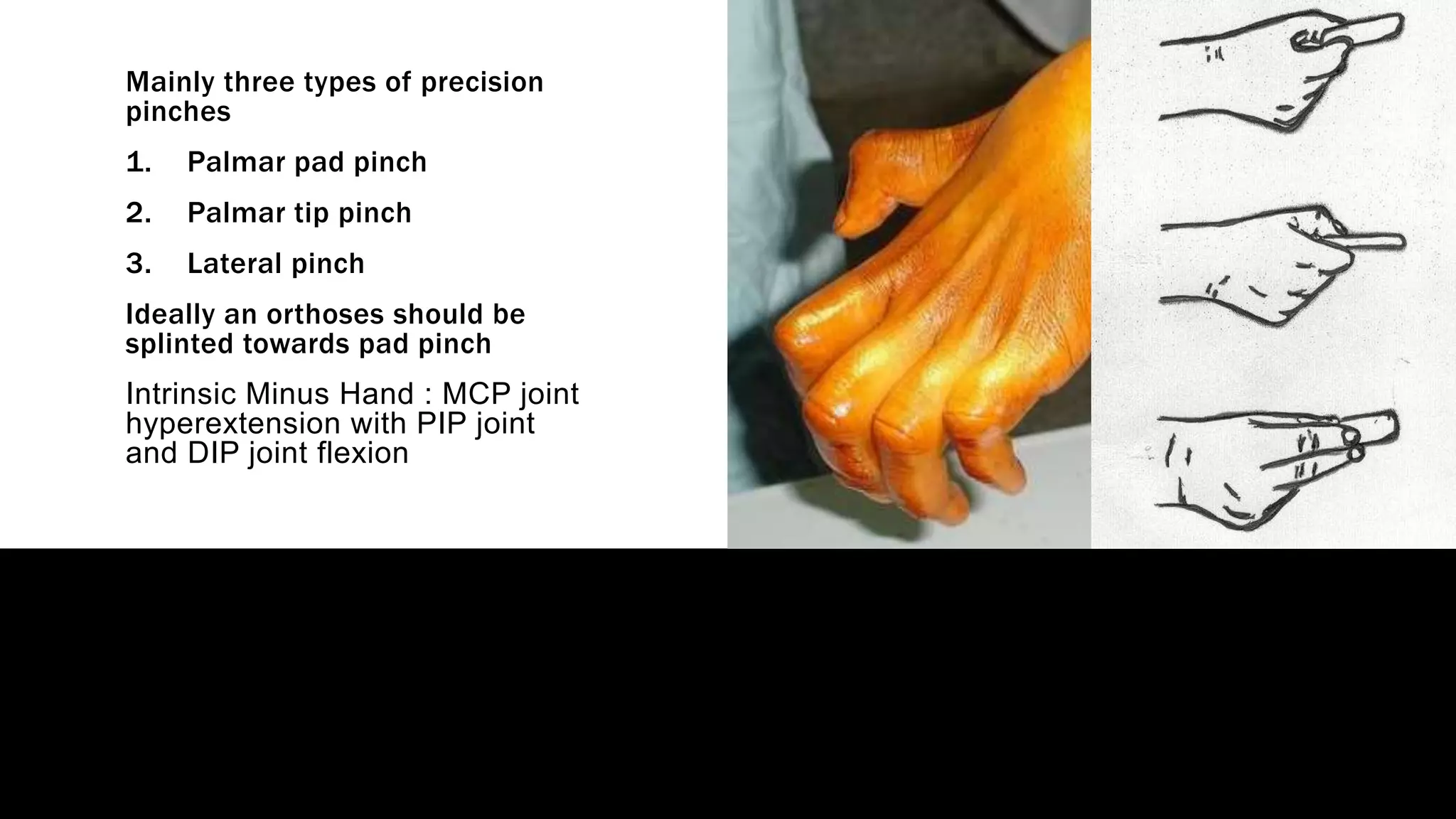 orthosis and prosthesis of upper limb | PPTX