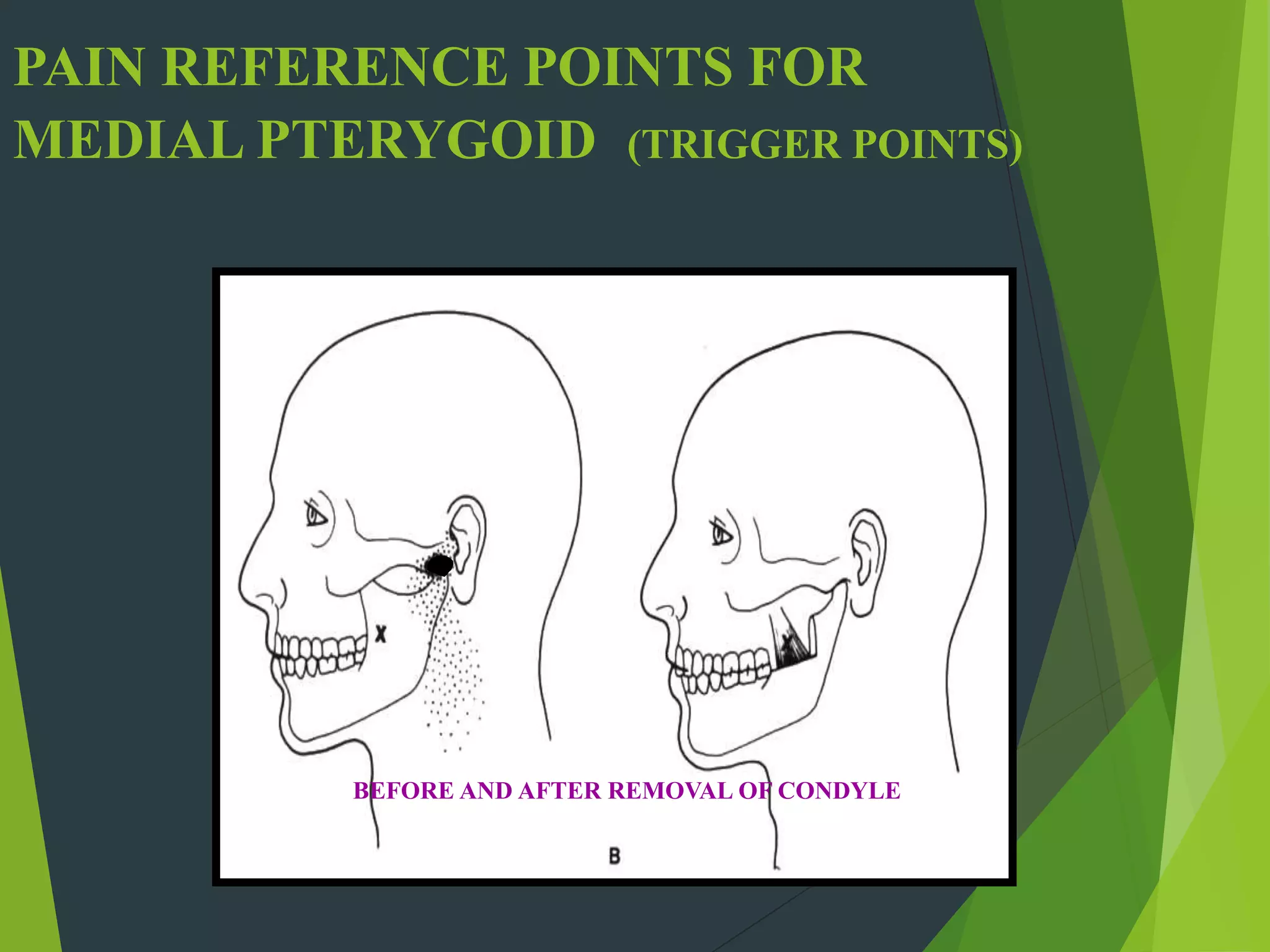 Myofacial pain dysfunction syndrome anindya | PPTX