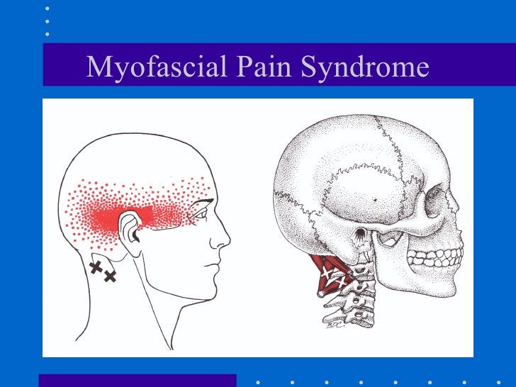 Myofascial pain syndrome