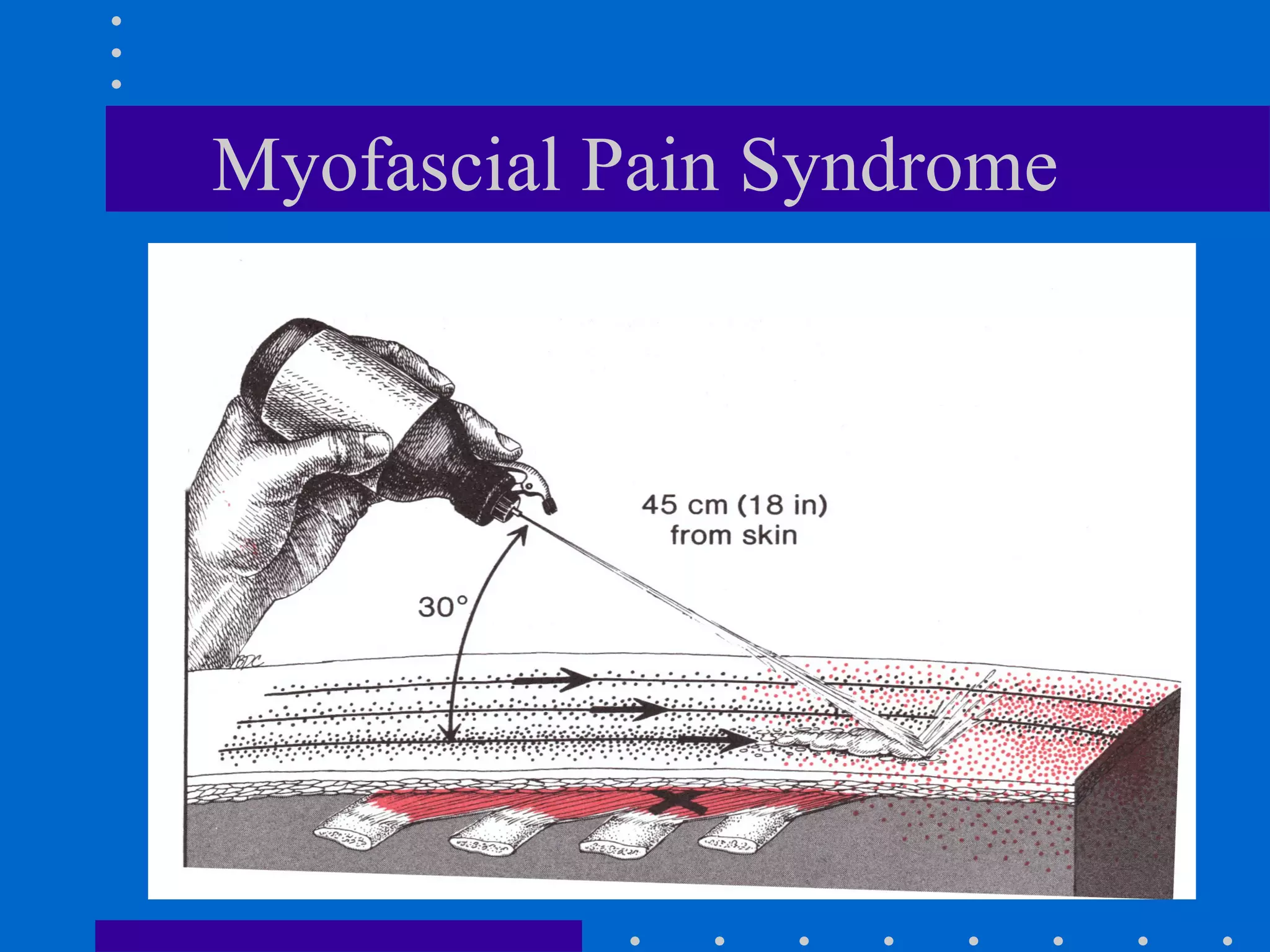 Myofascial Pain Syndrome | PPT | Physical Therapy | Wellness
