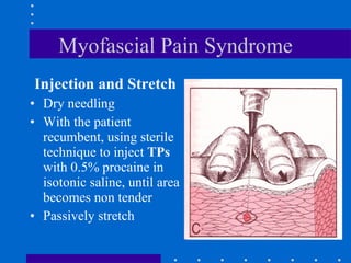 Myofascial Pain Syndrome | PPT