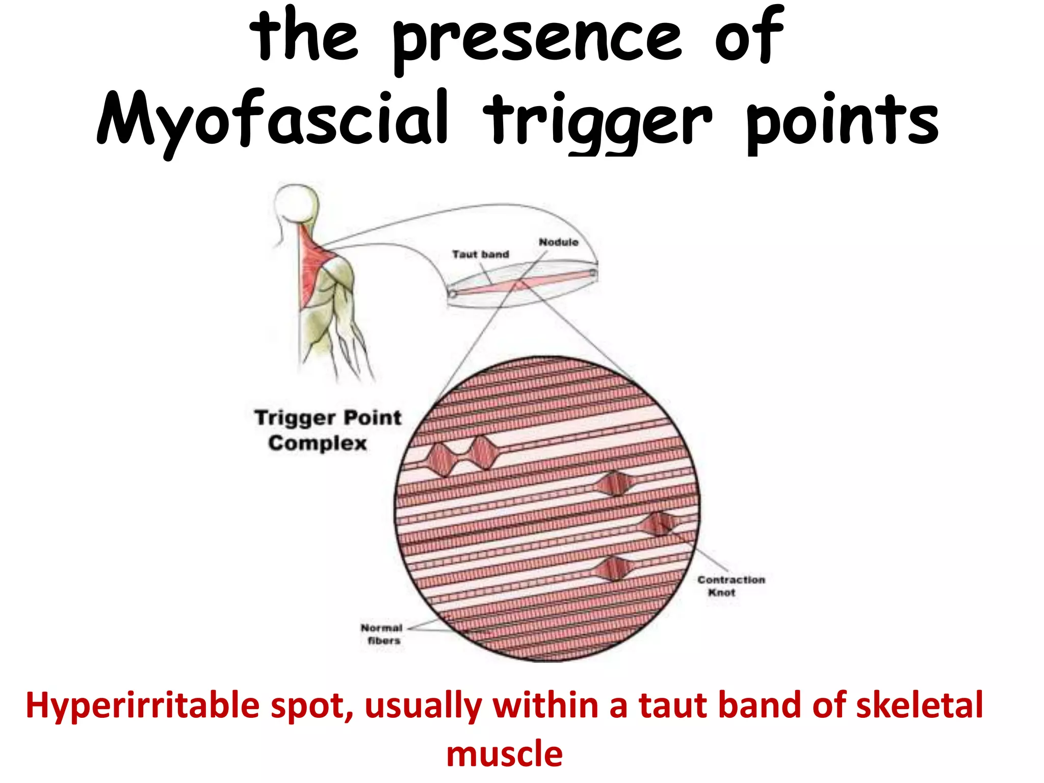 Myofascial pain conditions causing low back pain | PPTX