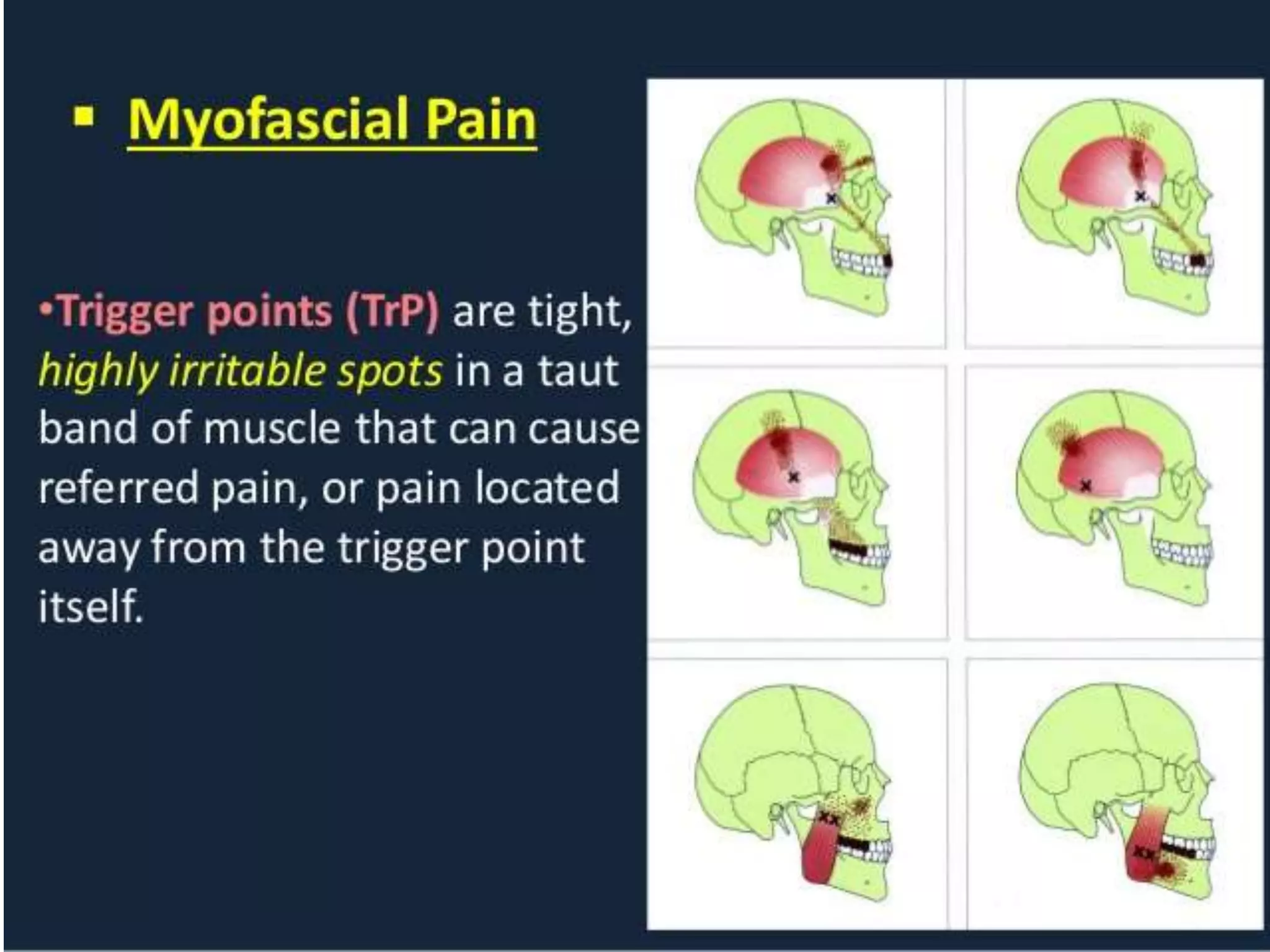 Myofascial pain dysfunction (mpd) | PPTX | Dental Health | Diseases and ...