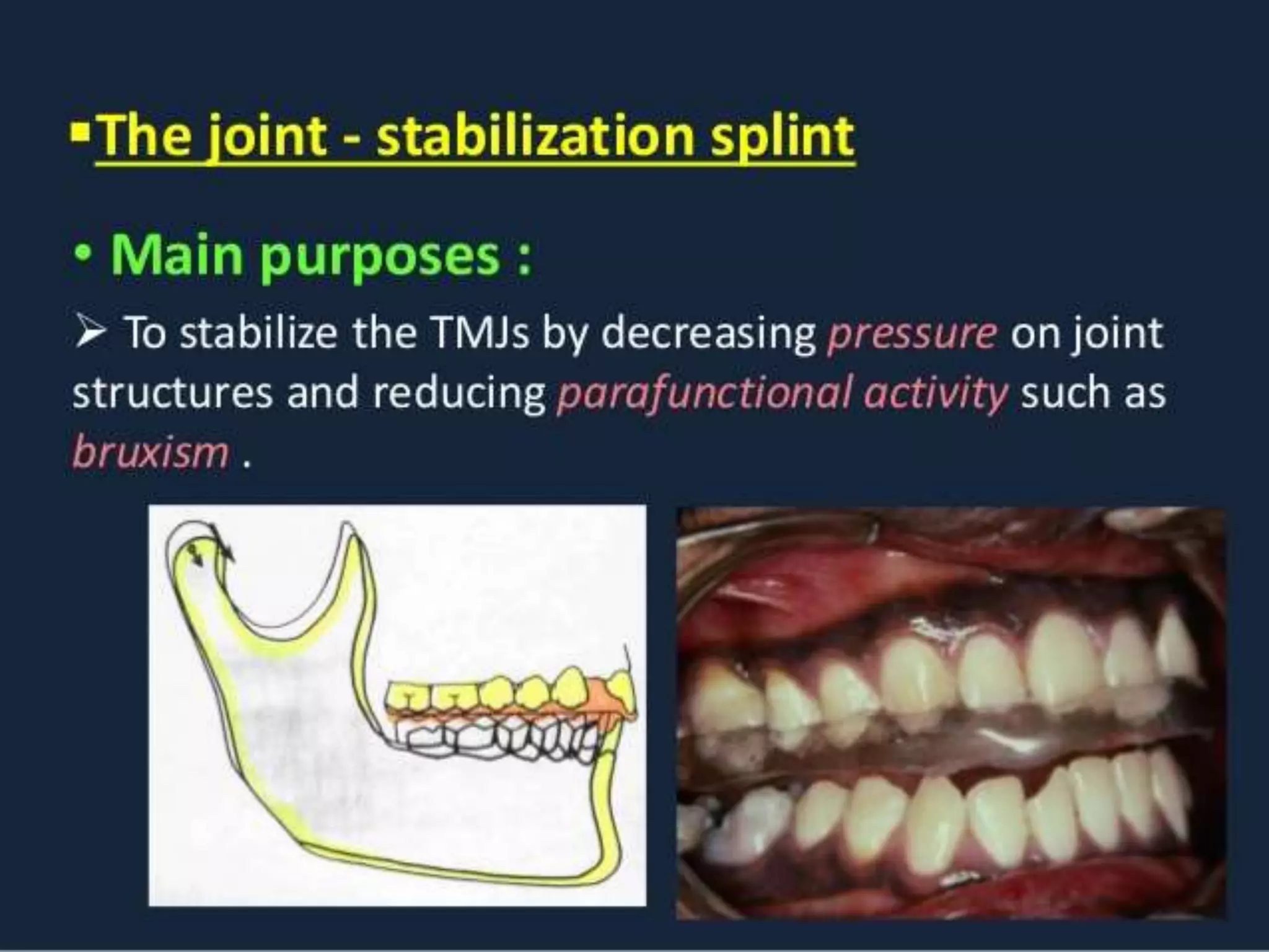 Myofascial pain dysfunction (mpd) | PPTX
