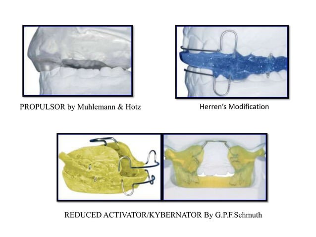 Myofunctional Appliances | PPTX
