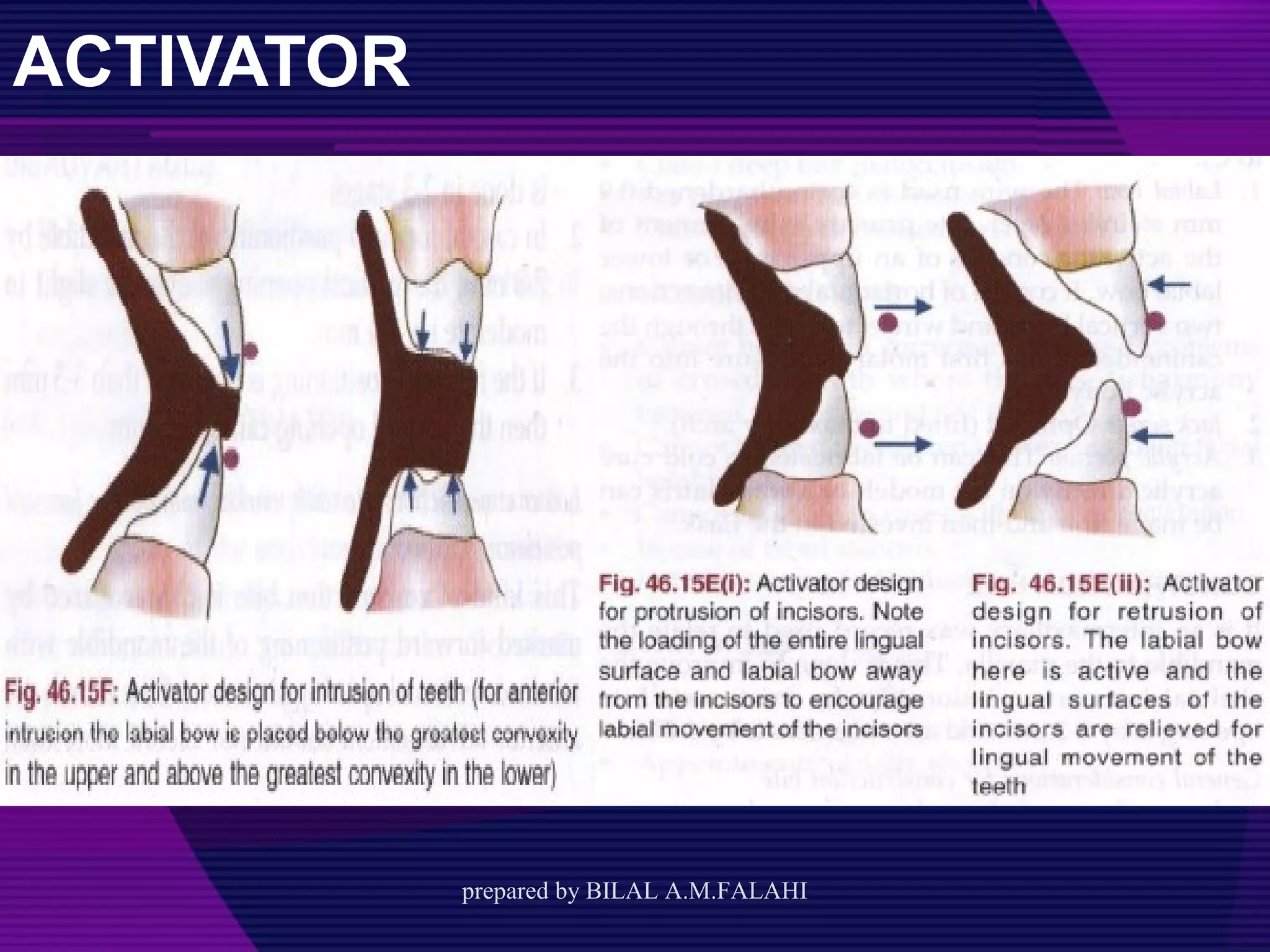 Myofunctional appliances in orthodontic | PPT