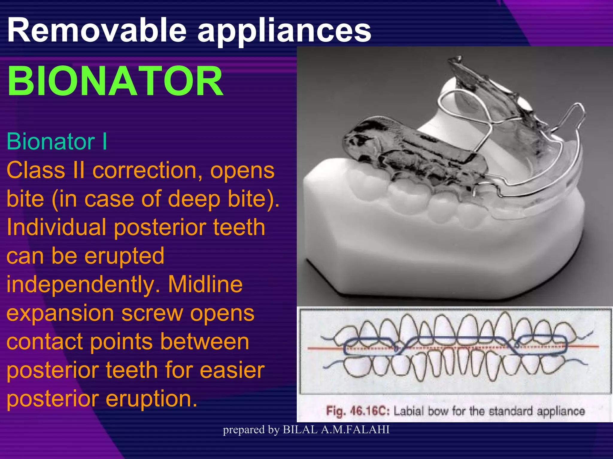 Myofunctional appliances in orthodontic | PPT