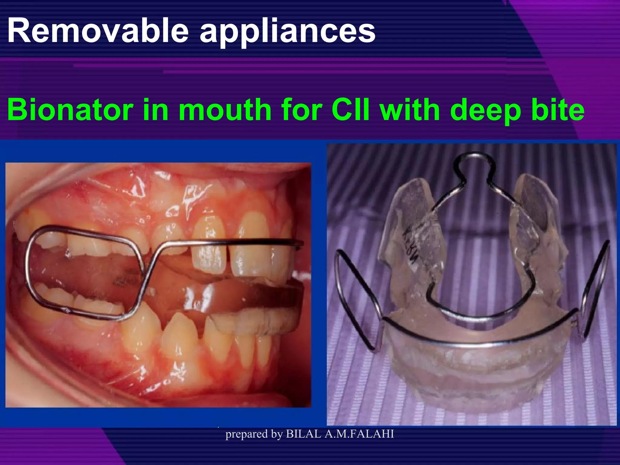 Myofunctional appliances in orthodontic | PPT