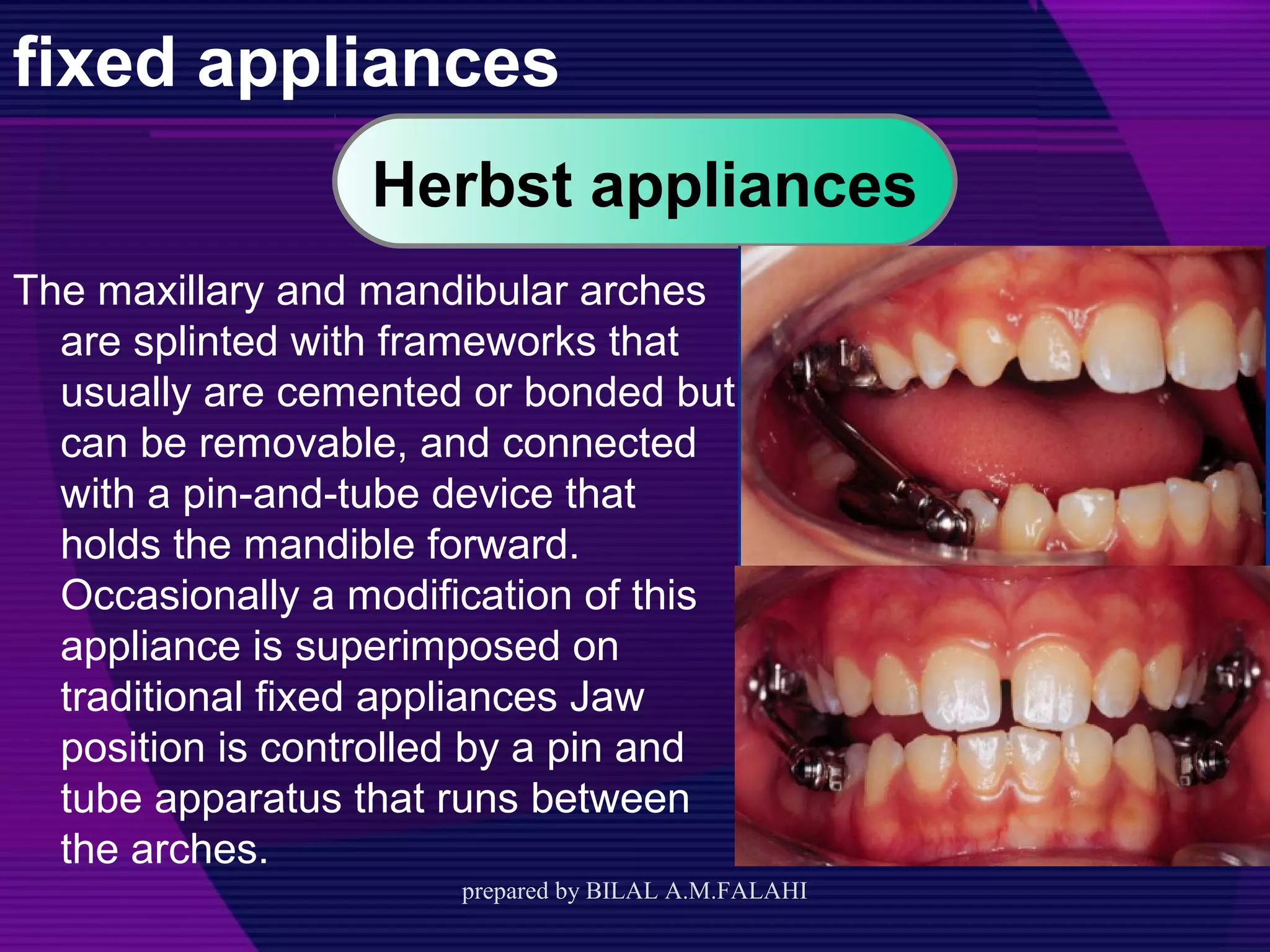 Myofunctional appliances in orthodontic | PPT