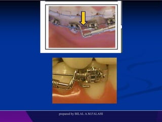 Myofunctional appliances in orthodontic | PPT